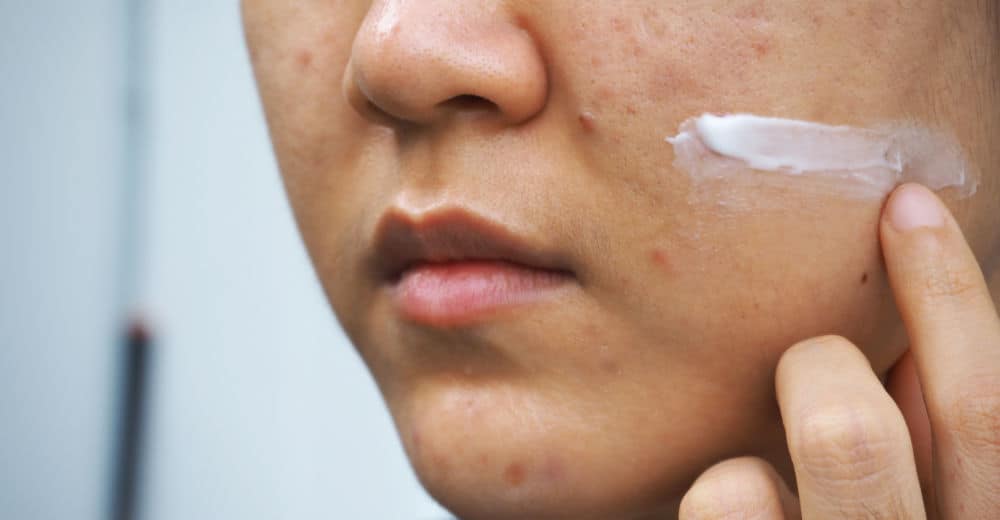 Acne articles - Dr Justine Kluk