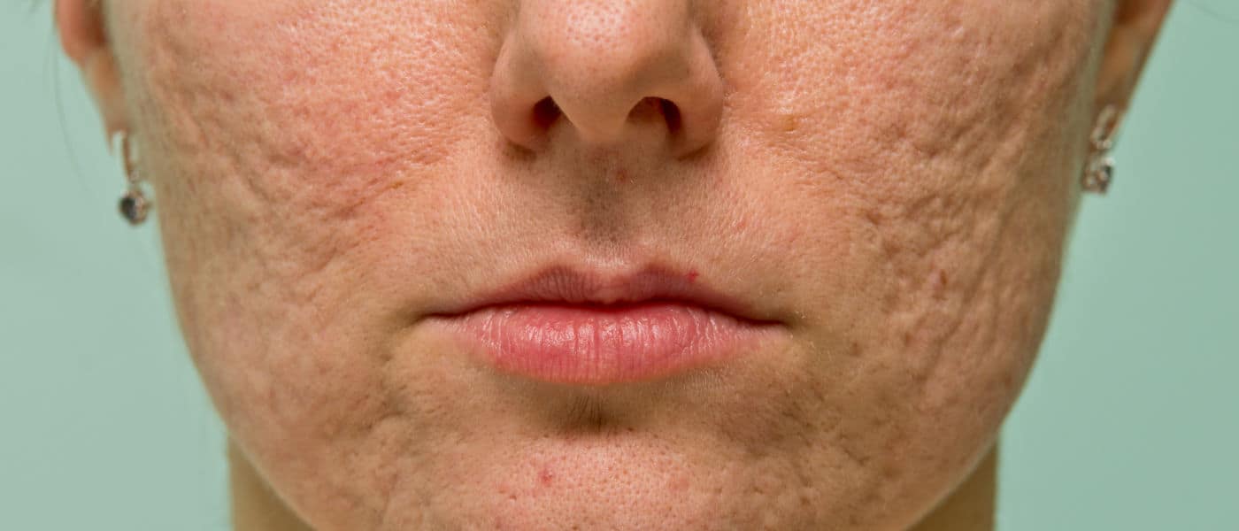 What is acne? - Dr Justine Kluk